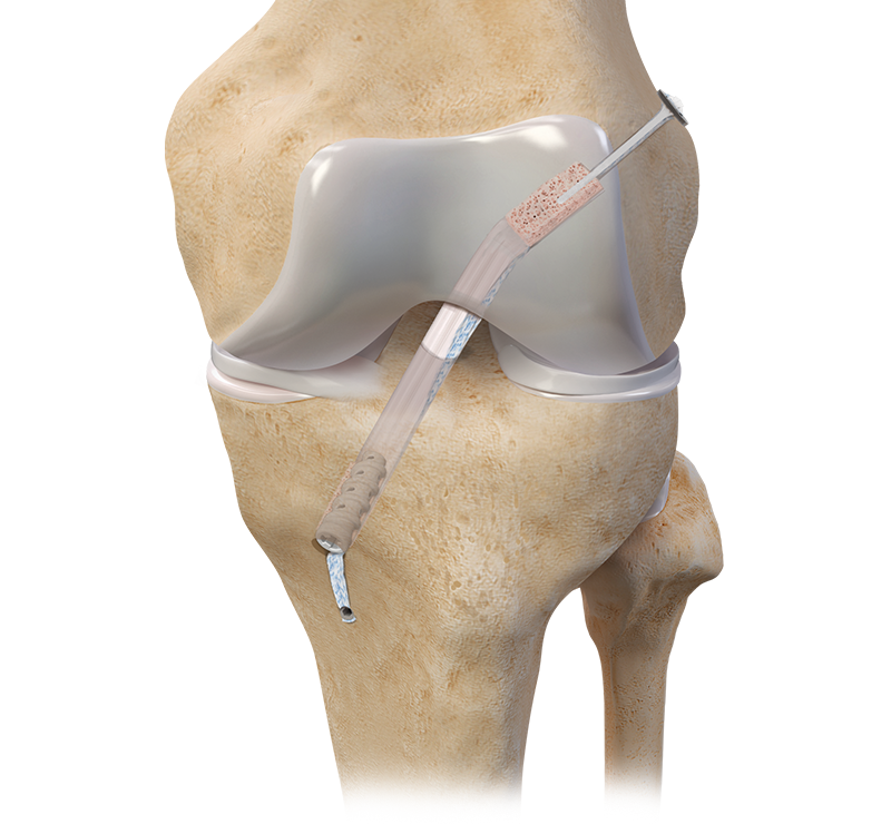 Arthrex - TightRope II BTB-IB Implant System, with Arthrex - TightRope II BTB-IB Implant System, with